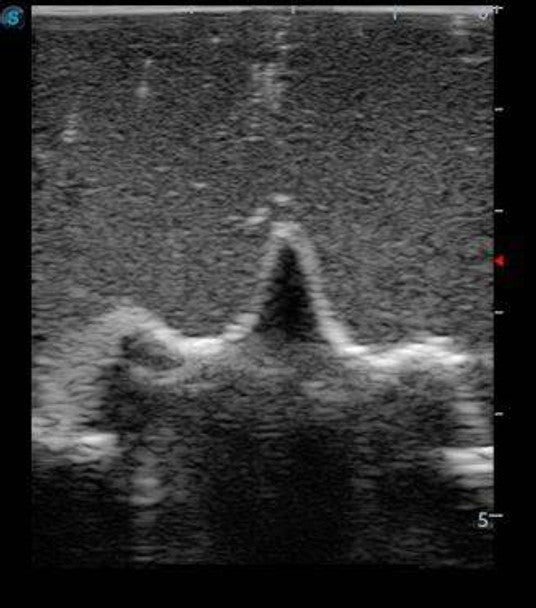 Paediatric Lumbar Puncture Ultrasound Training Model | AnatomyStuff