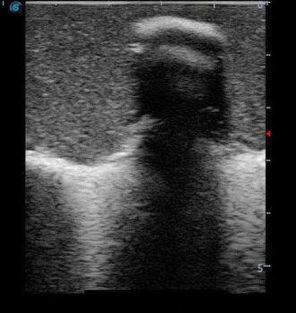Paediatric Lumbar Puncture Ultrasound Training Model | AnatomyStuff